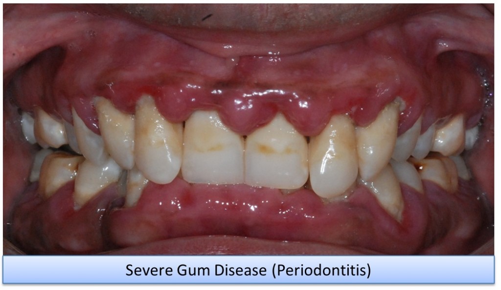 What is Gum Disease? – GTA North Periodontics & Endodontics